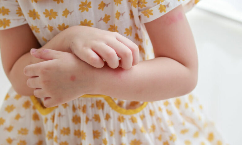 How to treat your child's skin rash | Rising Sun Newspapers
