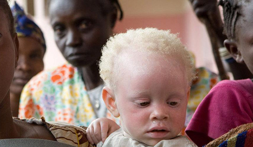 Internasionale Albinisme Bewusmakingsdag gevier | Vaalweekblad