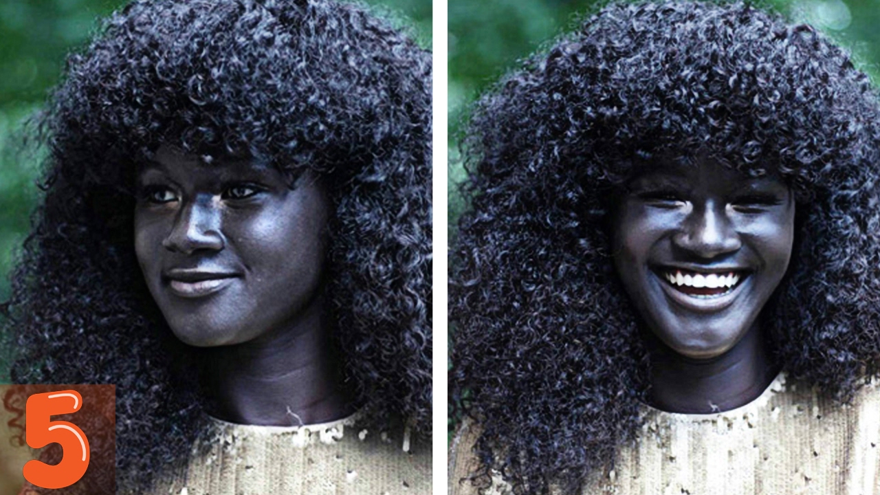 5 People With Unique Skin Colors | Heidelberg Nigel Heraut