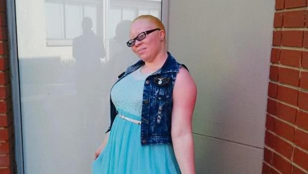 Activists fighting against albinism myths live life of fear | The Witness