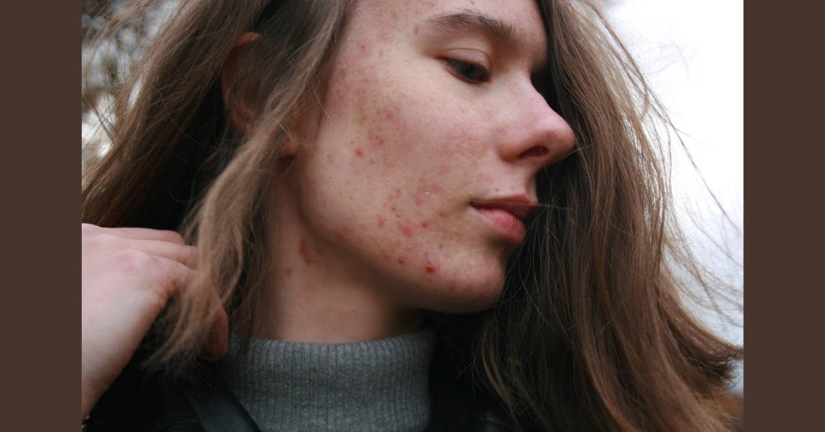 Five must-know dos and don'ts for oily, acne-prone skin