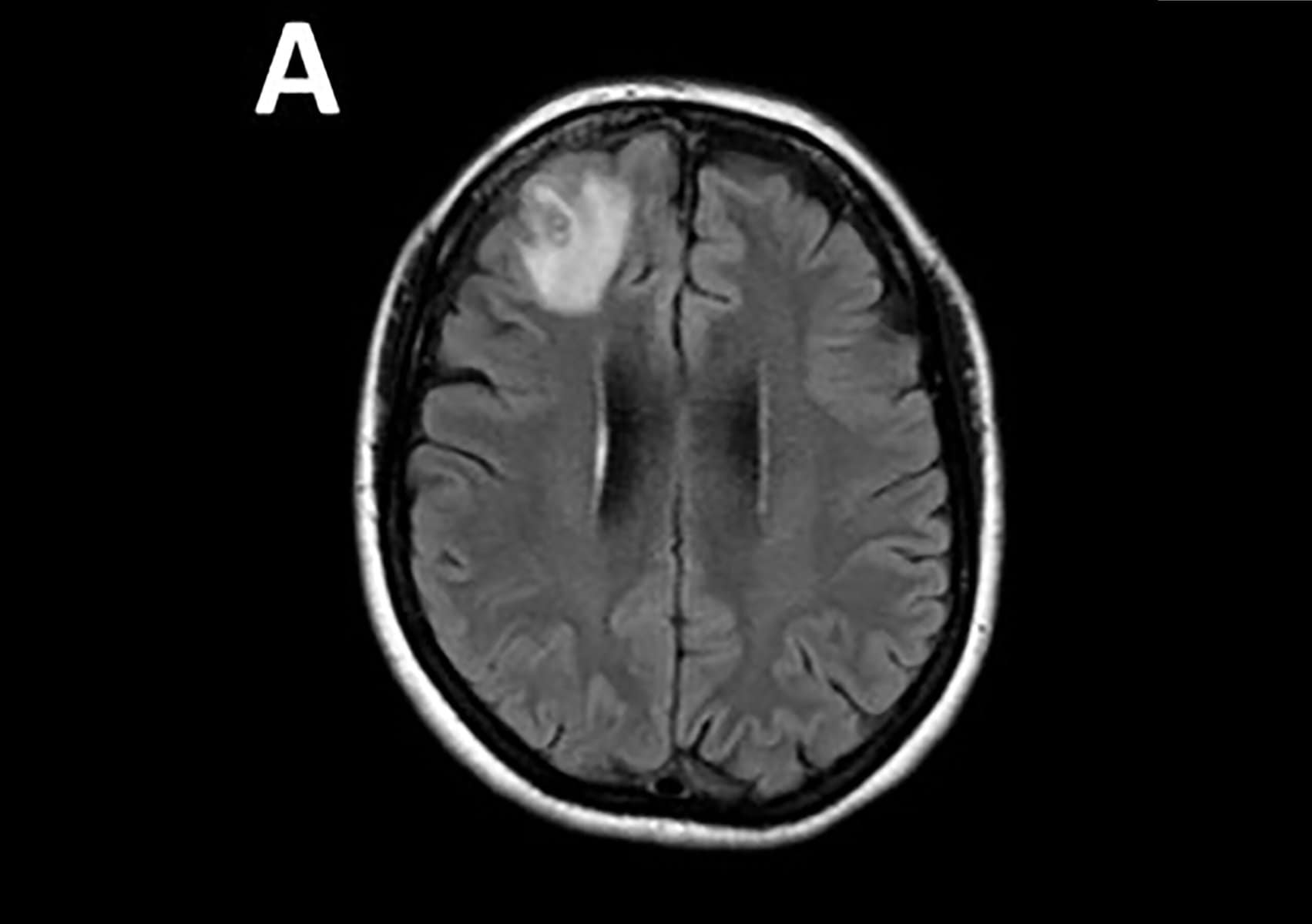Australian doctors find live parasitic worm in woman's brain | The Witness