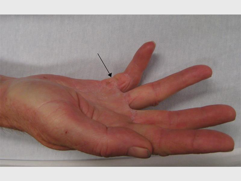 Hoe gemaak met winterhande en -voete? | Krugersdorp News