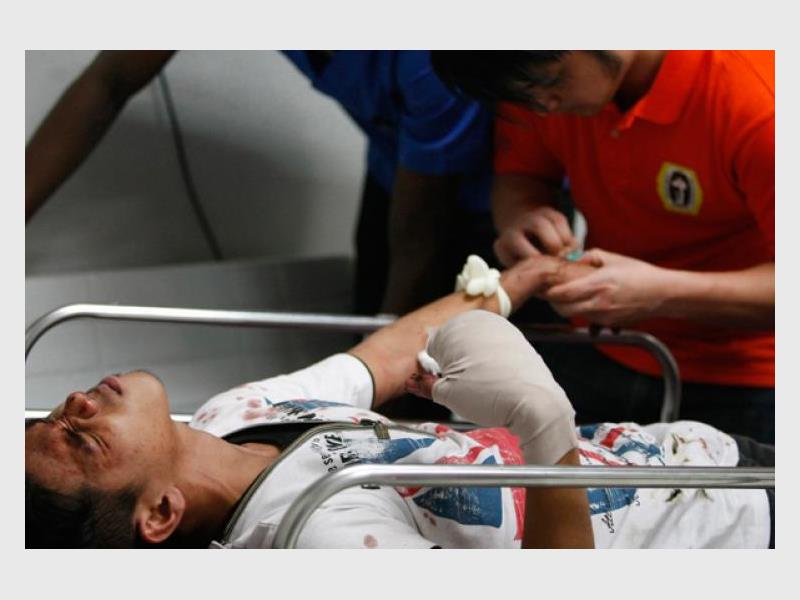 Treating firework injuries | Krugersdorp News