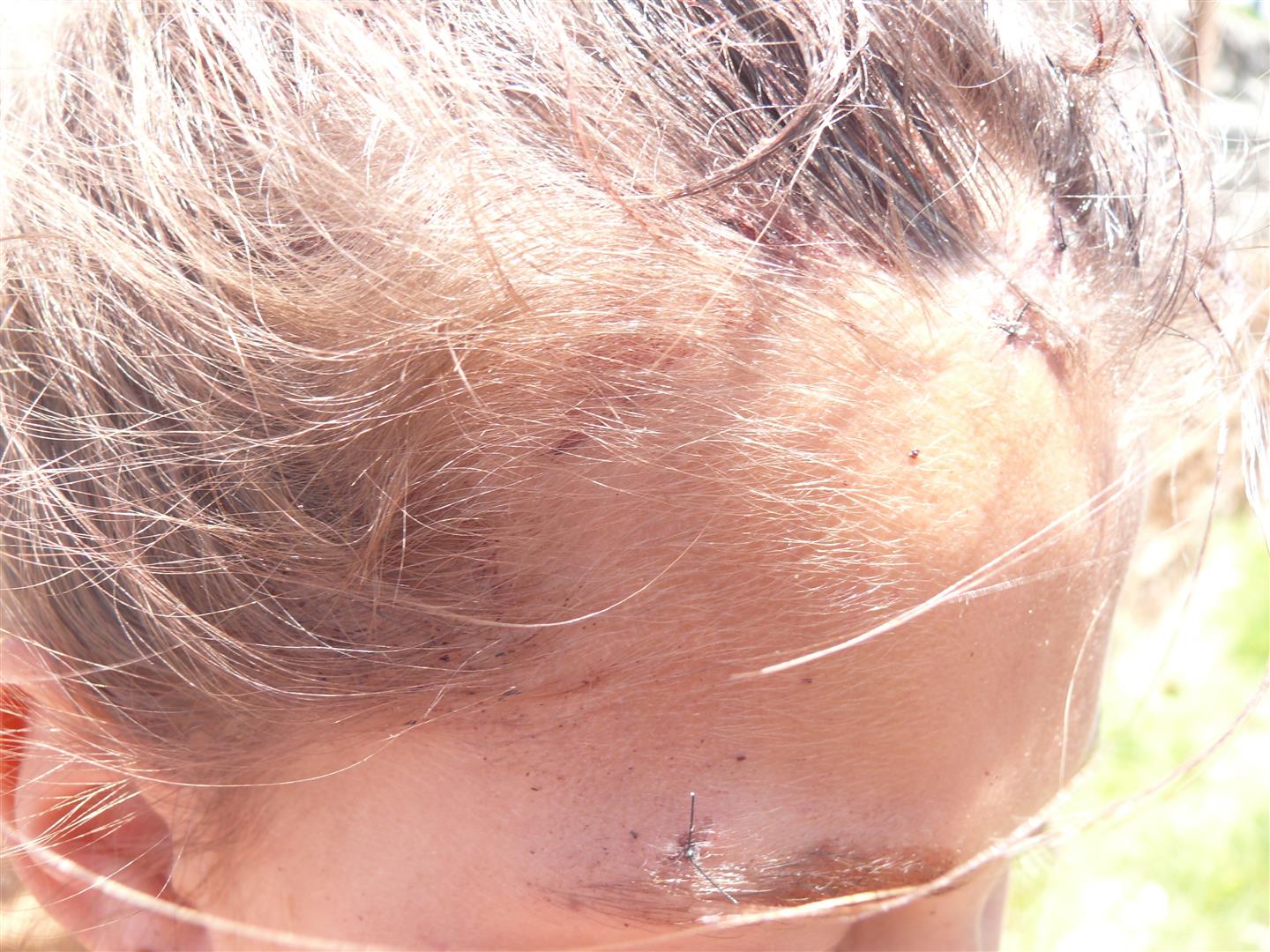 Pa sterf in ongeluk, ma en kind (13) steeds kritiek | Brakpan Herald