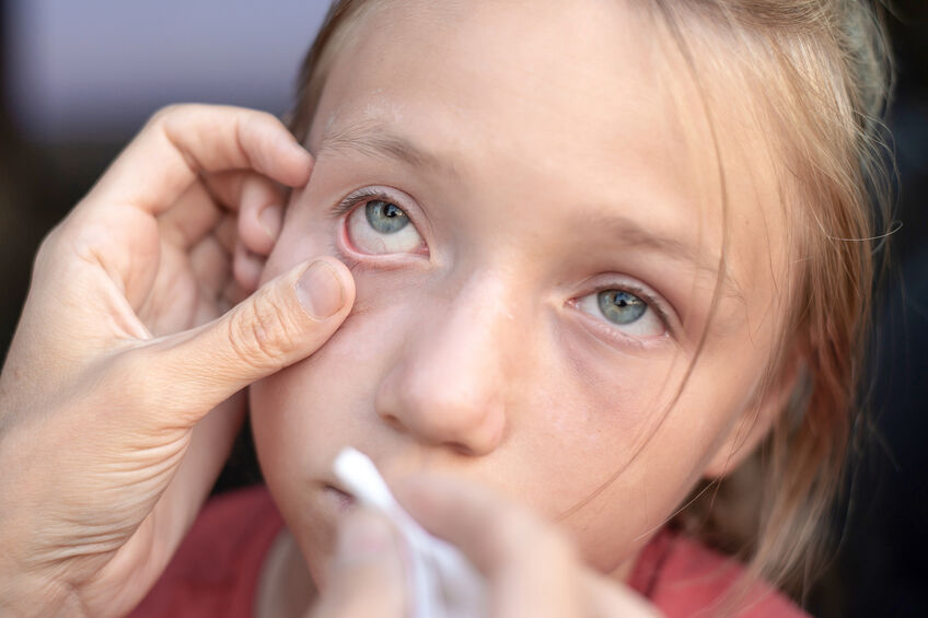 Help: My child has something stuck in their eye! | Southlands Sun