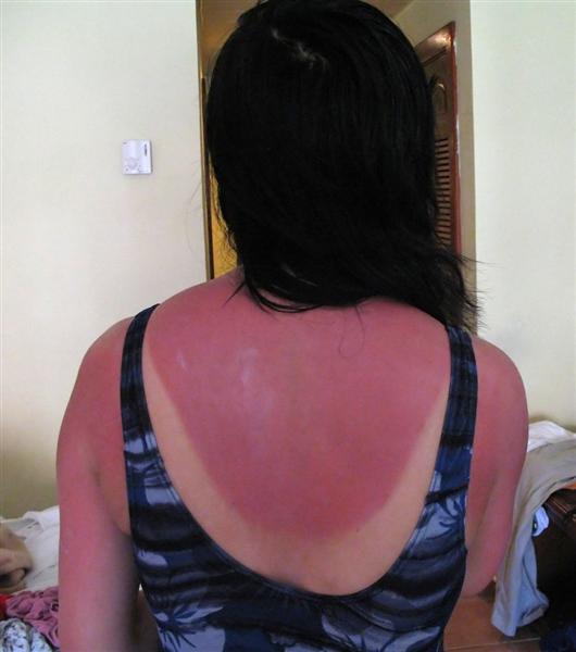 Sunburn can be serious - here's some useful advice | South Coast Herald