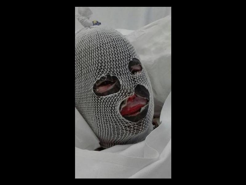 Burn victims all doing well | Rekord