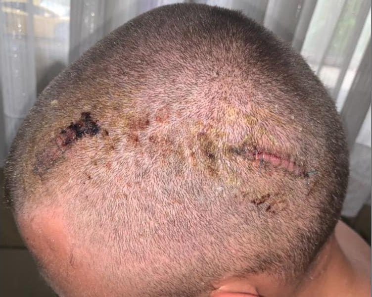 Man missing piece of his brain after botched surgery in Pretoria | Rekord