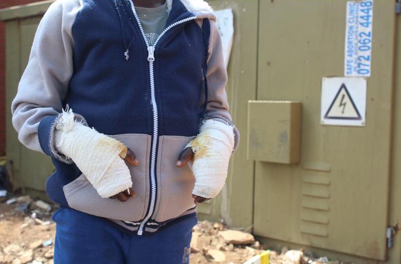 Boy (6) suffers serious burns after touching a transformer | Rekord