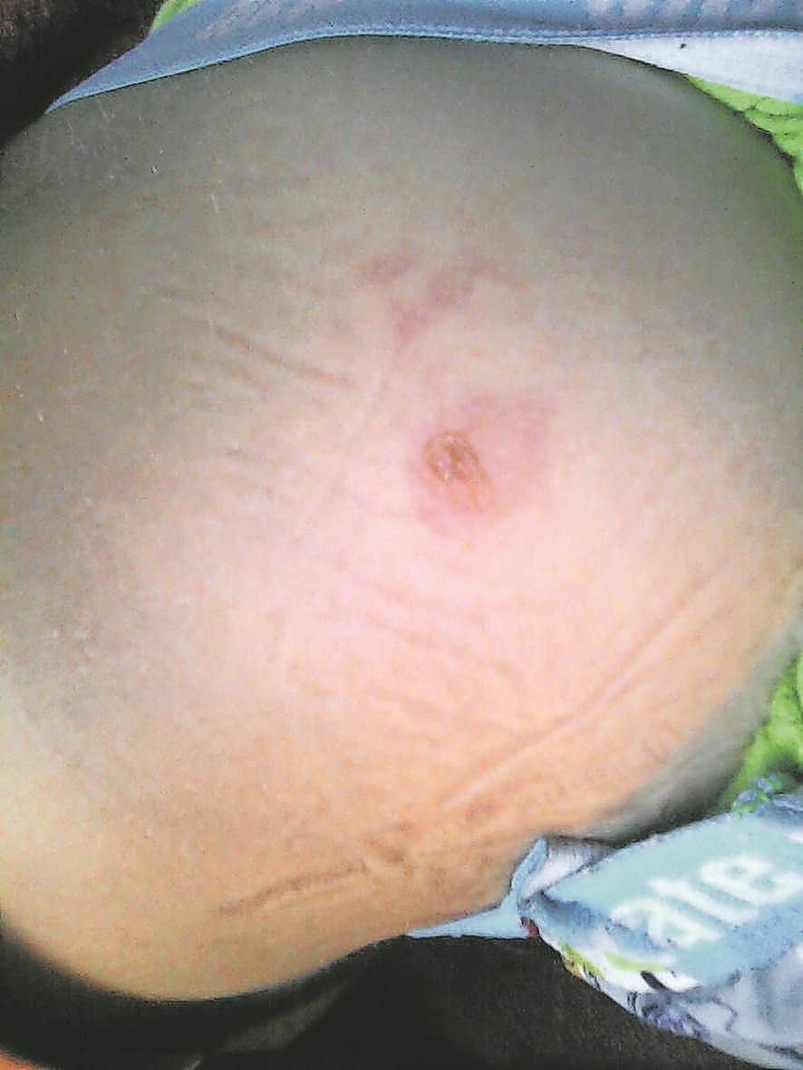 Sesjarige deur spinnekop gebyt | Middelburg Observer