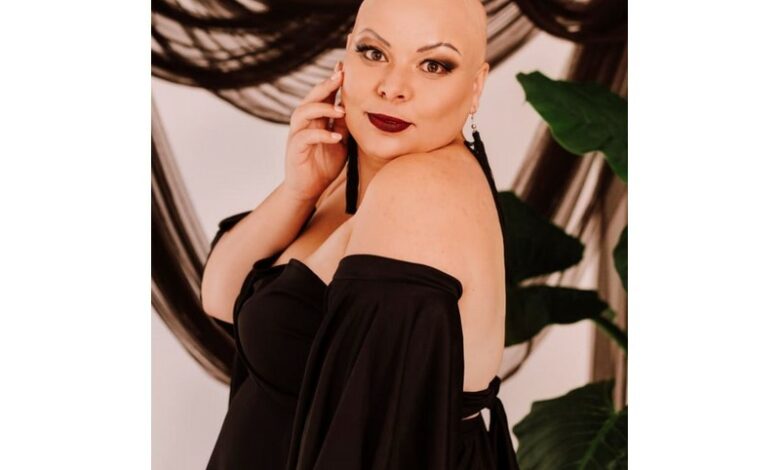 Ondersteuningsgroep vir mense met alopecia begin | Middelburg Observer