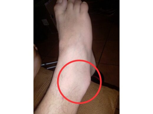 X-strale wys seun wat van fiets af gery is, se enkel is gebreek ...